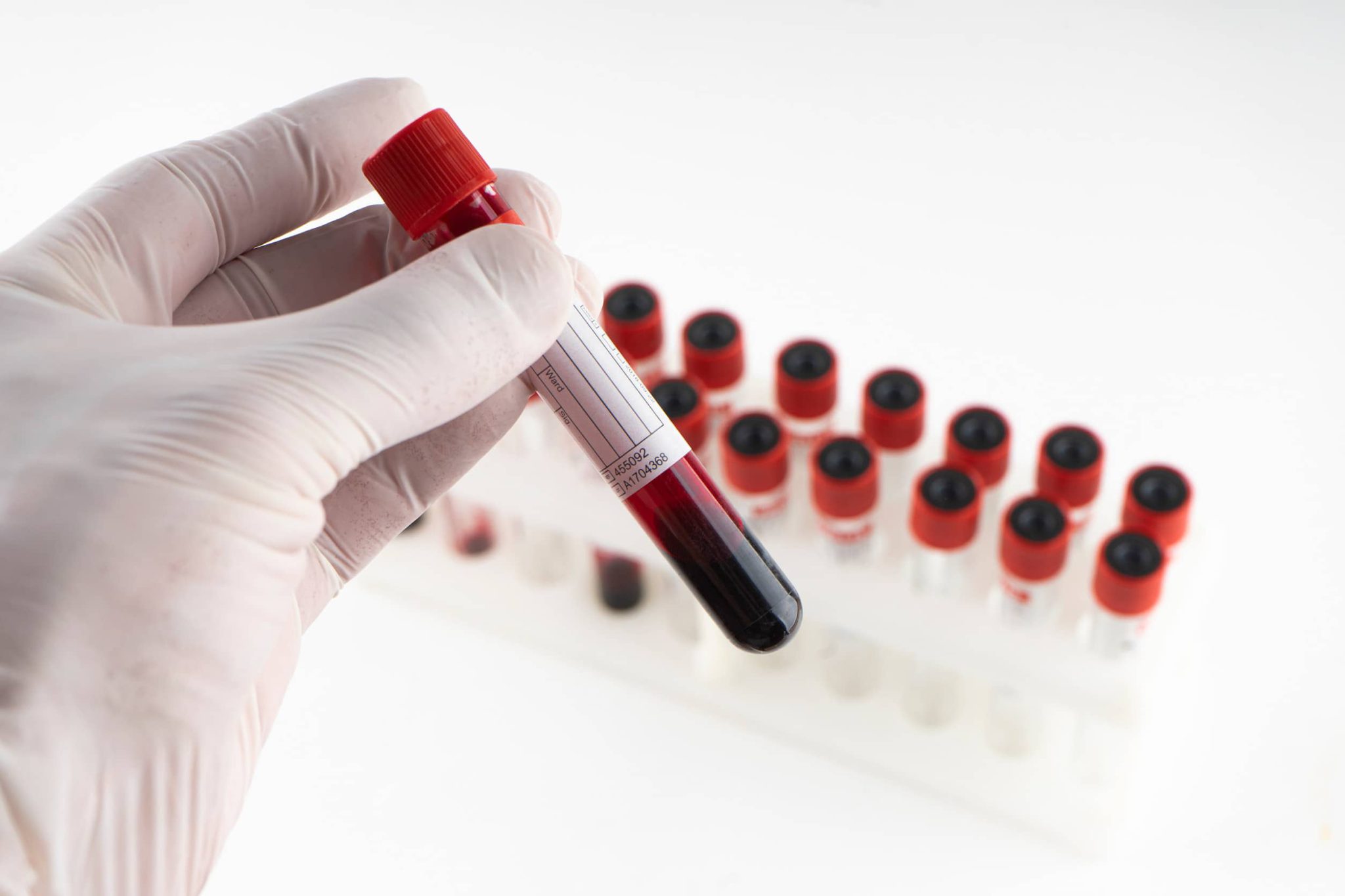 Erytrocyty - czerwone krwinki: normy, funkcje, przyczyny odchyleń i ...